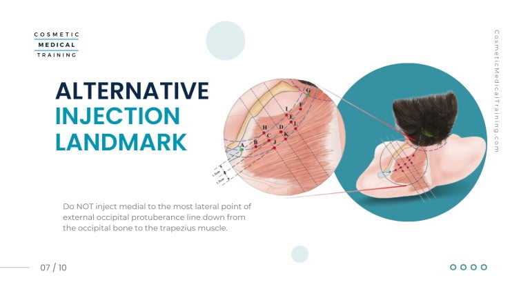Trap Tox; Botox Injection Technique Into the Trapezius Muscles